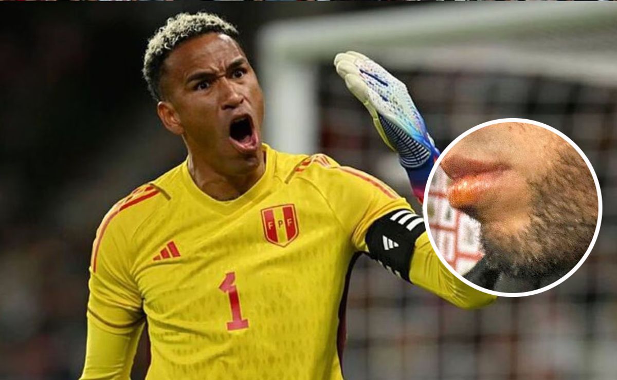 Así quedó el rostro Pedro Gallese tras impacto del balón en su rostro