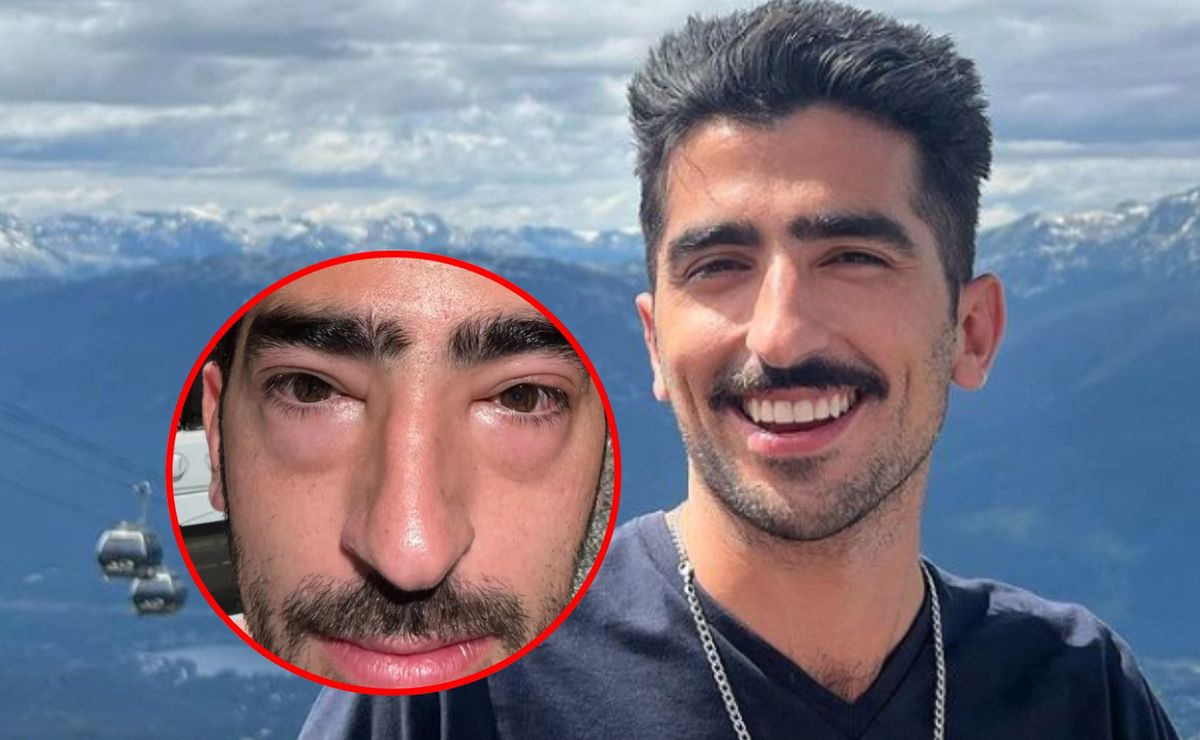 Jezzini: ¿Qué le pasó al influencer con la cara hinchada y por qué es ...