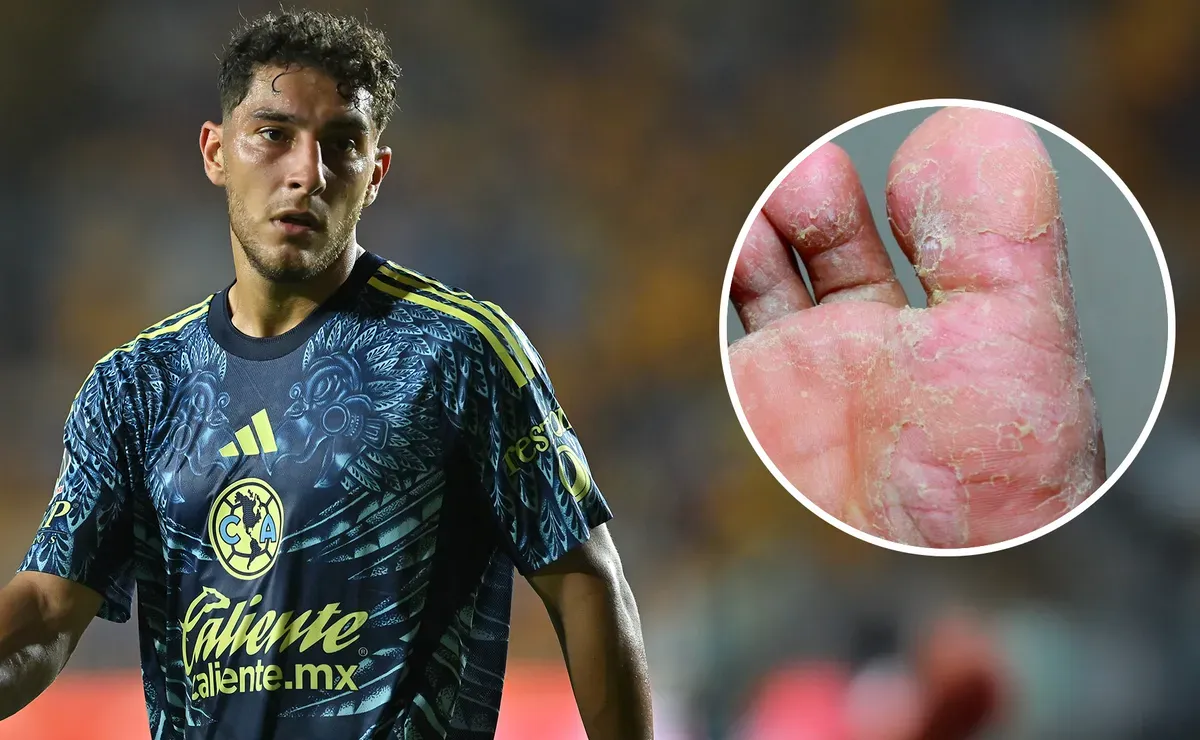 El hongo que no deja a Sebastián Cáceres jugar con el Club América