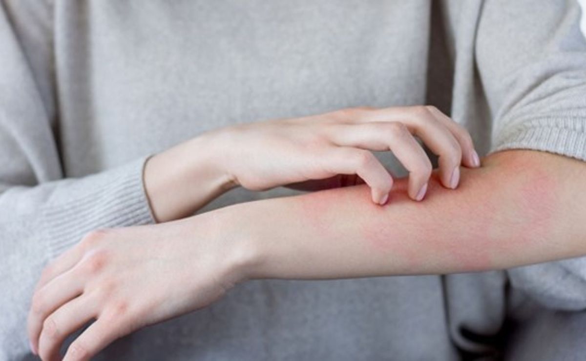 ¿Qué es la sarna y cómo se contagia? Confirman brote en cuarta región